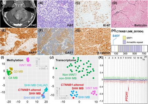A Ctnnb1‐altered Medulloblastoma Shows The Immunophenotypic Dna