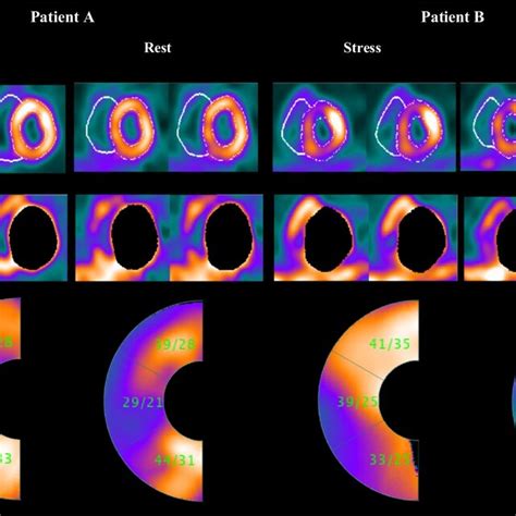 two sample patients right and left ventricular segmentation by