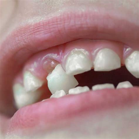 Dislodged Tooth Treatment Nyc Advanced Endodontics Care