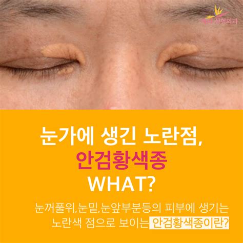 에버성형외과 안검황색종 눈주변의 노란색 점 안검황색종은 눈꺼풀위눈앞눈밑피부에까지 발생하는