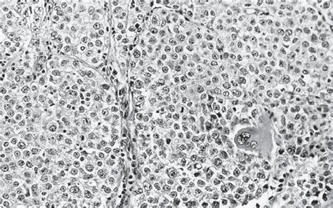 Dysgerminoma With Syncytiotrophoblasts Nests Of Clear Tumor Cells Are Download Scientific