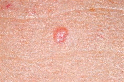 Basal Cell Cancer Coco Dermatology And Cosmetics Dermatologists