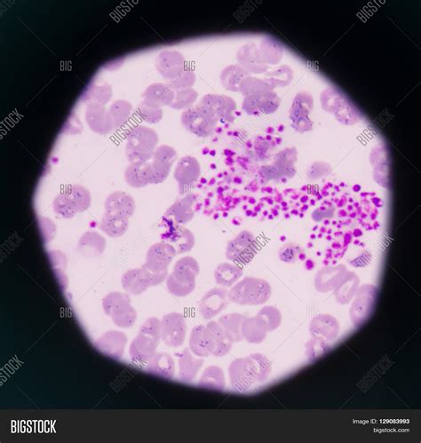 Pseudothrombocytopenia Image And Photo Free Trial Bigstock