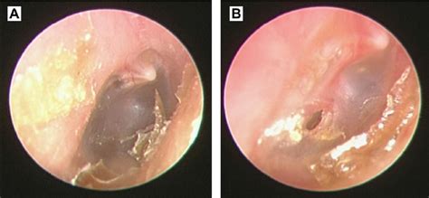 Tympanic Membrane Otitis Media Effusion