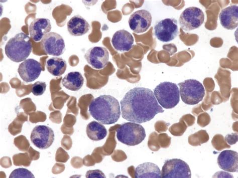 Myelodysplastic Myeloproliferative Neoplasm With Neutrophilia Stock Image Image Of