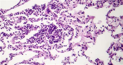 Treatments And Medications National Scleroderma Foundation