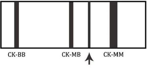 Pathology Outlines Ck Mb Creatine Kinase Isoenzyme Mb