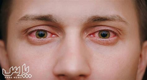 علت قرمز شدن چشم چیست؟ دلیل های قرمزی چشم