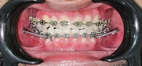Drrajat Soni On Linkedin Buccal Shelf Implants For Mandibularfull