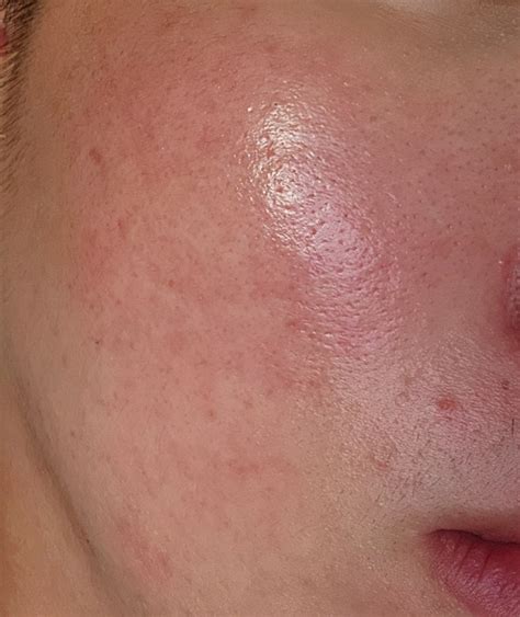 여드름 붉은기 개선부탁드립니다얼굴 사진있습니다 지식in