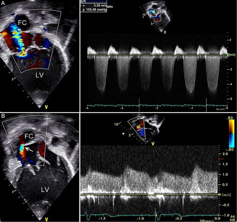Role Of Imaging In The Evaluation Of Single Ventricle With The Fontan