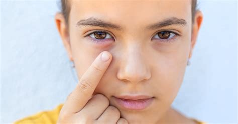 Ni Conjuntivitis Ni Orzuelo Esta Es Otra Enfermedad Ocular Que