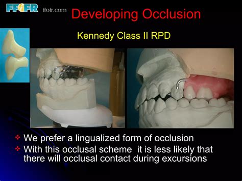 10maxillo Mandibular Records Ppt