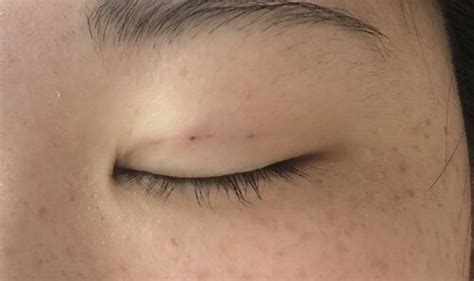 埋没法後の瞼の黒い点について 目・二重整形の治療への不安（痛み・失敗・副作用）