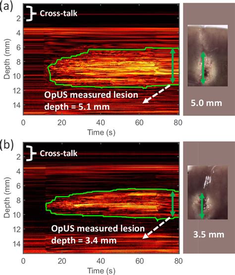 Figure 3 From Miniaturised Dual Modality All Optical Ultrasound Probe For Laser Interstitial