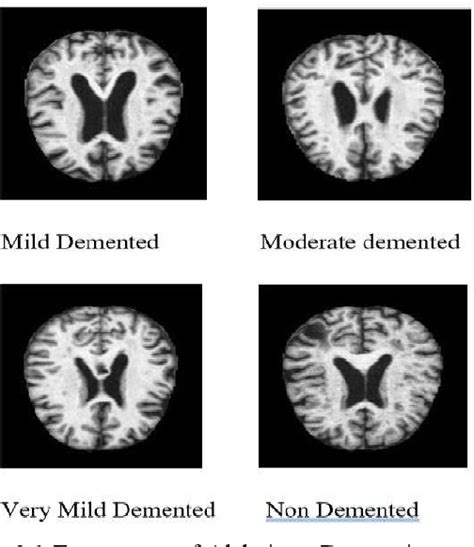 figure 3 1 from prediction and classification of alzheimer s disease