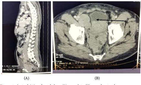 Figure 1 From Thyroid Metastasis Revealing Prostatic Adenocarcinoma Semantic Scholar