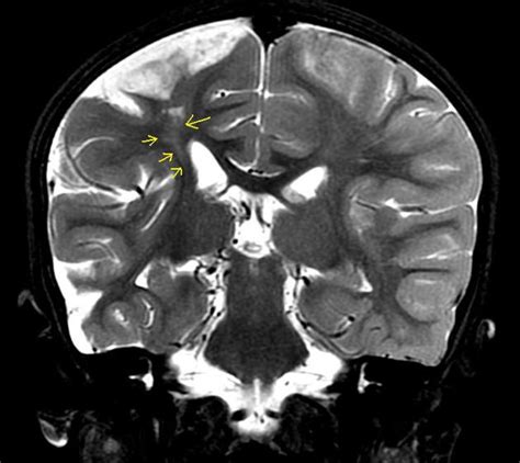 Peripheral Nerve Injury Classification Pacs
