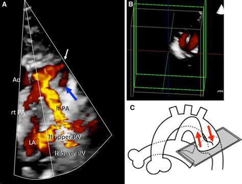 Three Dimensional Color Doppler Echocardiography Recorded From The High Download Scientific
