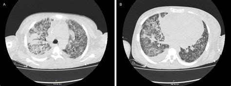 Fatal Co Infection By Multiple Pathogens In An Indigenous Woman With