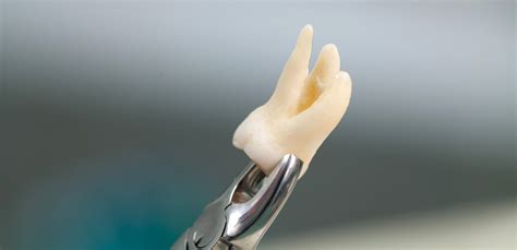 Wisdom Tooth Extraction Recovery Seos Wisdom Teeth V1