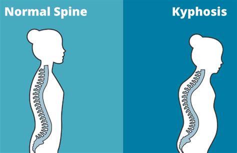 Kyphosis Solutions Proactive Physiotherapy West Kelowna Bc
