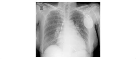 Cephalization Of Pulmonary Vessels