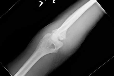 Orthodx Elbow Dislocation Clinical Advisor