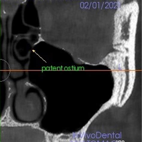 Maxillary Sinus Perforation Treatment