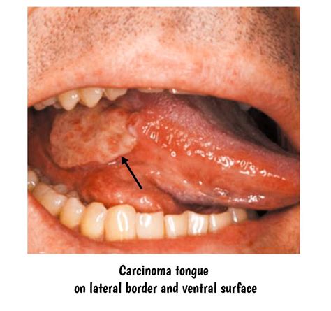 Base Of Tongue Cancer