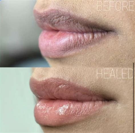 Dark Lips Neutralization Lip Correction Montreal