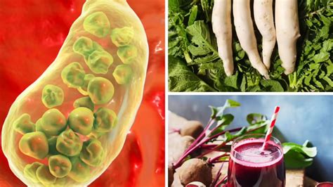 Gall Bladder Stone Kyo Hota Hai Archives Shabd Sanchi