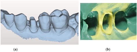 Analysis Of The Reproducibility Of Subgingival Vertical Margins Using