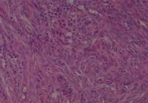 Novus Biologicals Human Ovary Tissue Microarray Metastatic Cancer