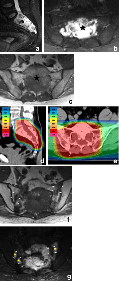 Sacral Insufficiency Fractures After High Dose Carbon Ion Based