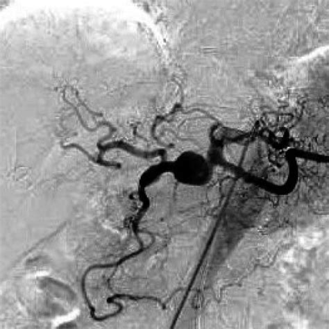 Ruby Coil Medicos Hirata Target Xxl Coil Stryker Micrusframe Download Scientific Diagram