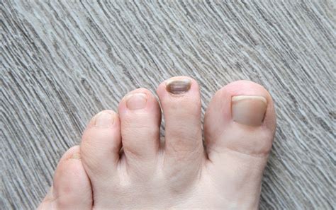 Runners Toe Causes Symptoms And Prevention