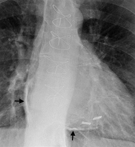 Cardiac And Pericardial Calcifications On Chest Radiographs Clinical