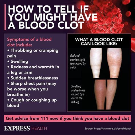 Deep Vein Thrombosis Symptoms Six Early Stage Signs In Your Leg