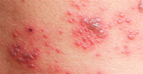 Shingles A Very Painful Rash Lumby Valley Times