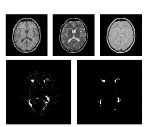 Ms Lesion Segmentation Top From Left To Right T1 T2 Pd Weighted Download Scientific