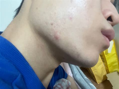 저기 가장 빨간 여드름 지식in