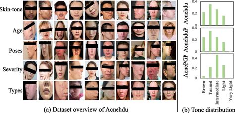 Dataset Overview Both Samples In Acnehdu And Skin Tone Distributions