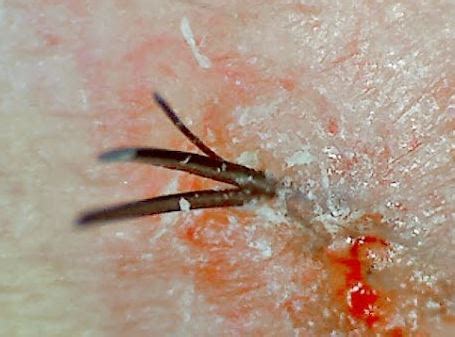 Multiple Two Hairs One Follicle Pubic Area Scalp Armpit Get Rid Prevent