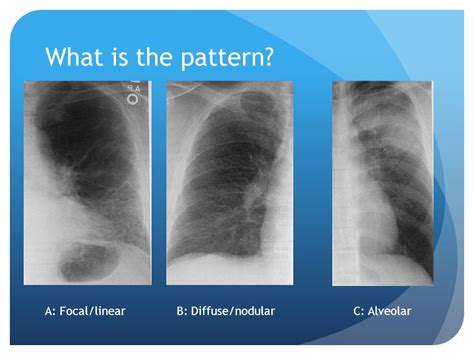 Chest X Ray Interpretation For The Internist Ppt Download