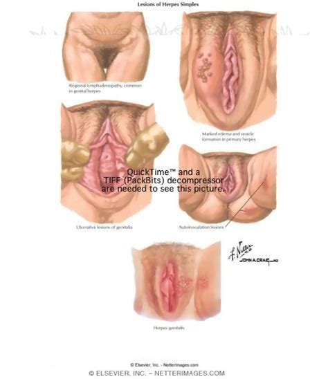 Sexually Transmitted Infections Herpes