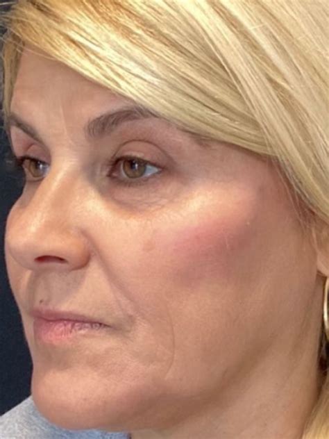 Treatments For Sunken Cheeks