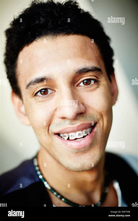 Braces Colors For Dark Skin
