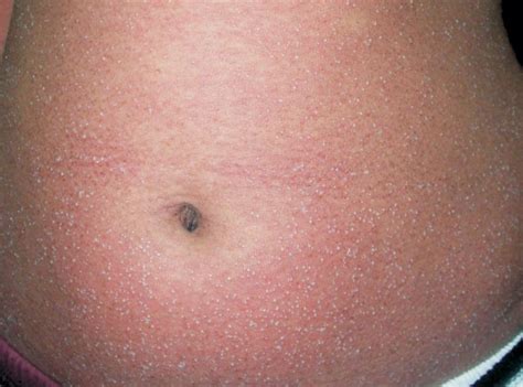 Diffuse Erythematous Rash
