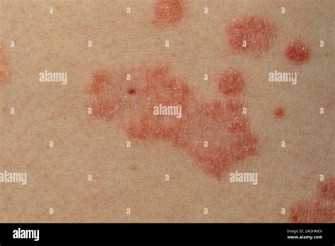 Psoriasis Lesions On The Skin Of A 28 Year Old Man With Chronic Plaque